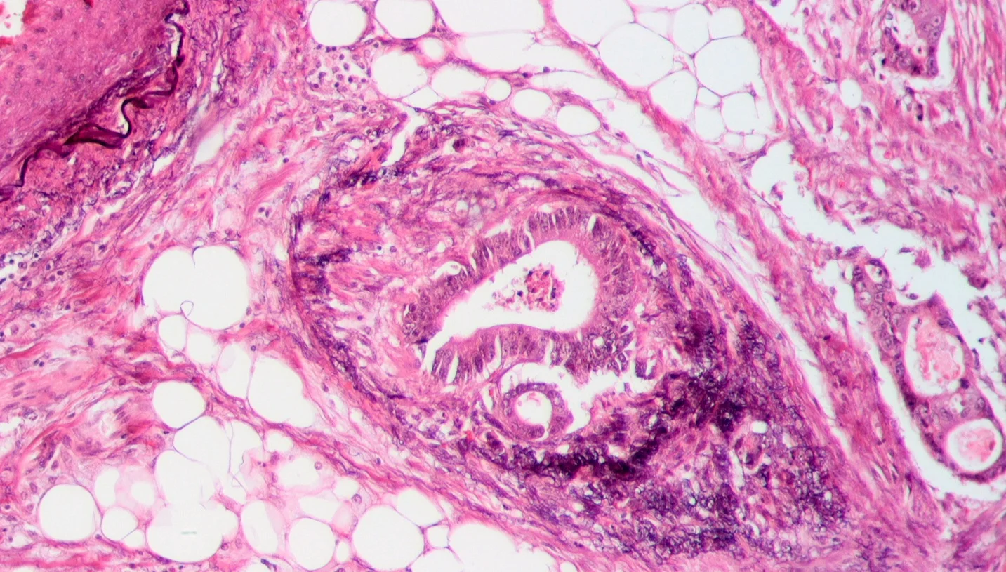 FDA grants fast track status to Agenus’ colorectal cancer combination ...