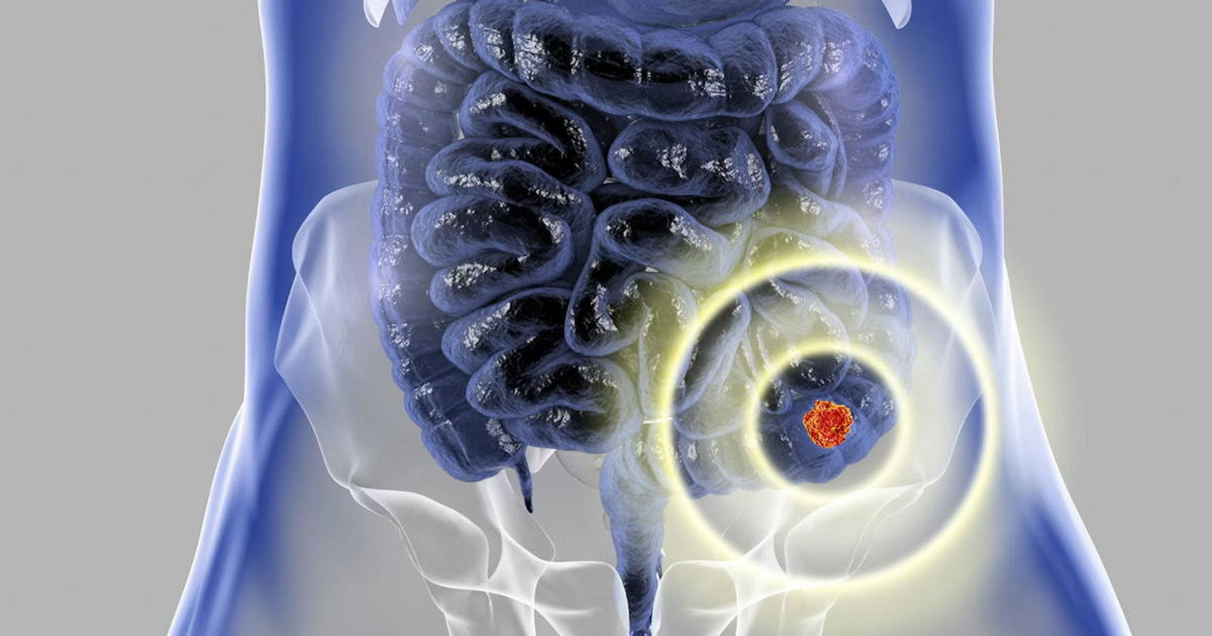 Oncocyte announces results for gene expression test in colorectal ...