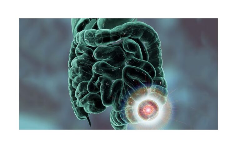 Key Red Flags for Early-Onset Colorectal Cancer (Medscape) - Scope Forward