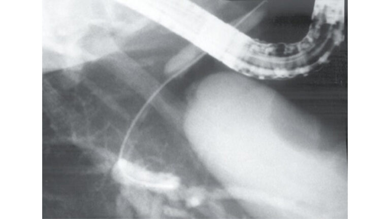 10 Tips for Quality ERCP (GI & Endoscopy News) - Scope Forward