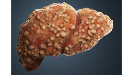 New ACG Guideline on Acute Liver Failure (Gastroenterology & Endoscopy ...