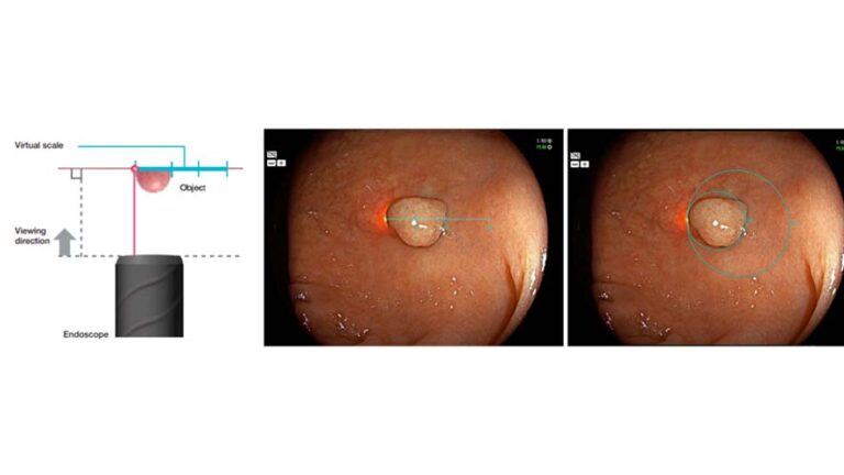 FDA Clears Endoscopy Scale System (Gastroenterology & Endoscopy News ...