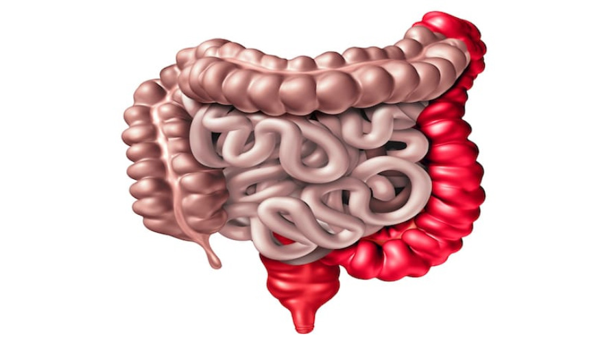 Lab-grown ‘mini guts’ to help identify treatment for Crohn’s disease ...