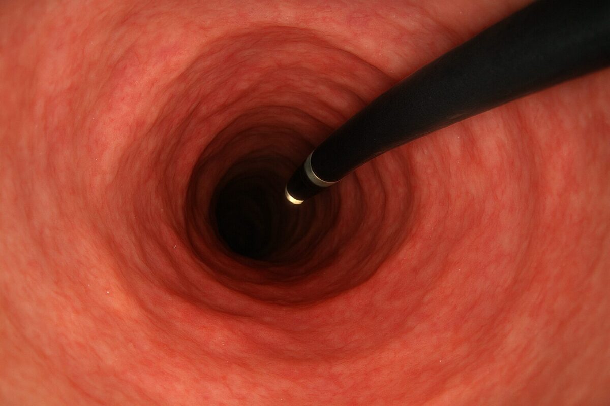 How a minimally invasive endoscopic procedure is transforming GI cancer ...